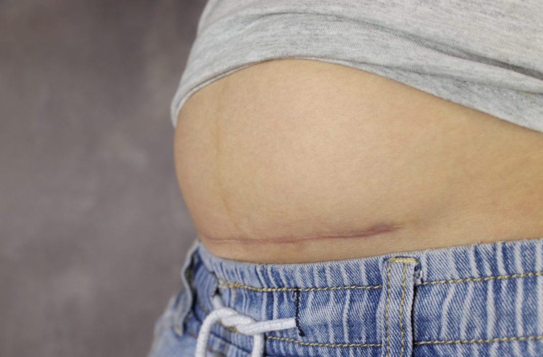 Ways To Keep The C-Section Incision Dry When Overweight - The Shoe Box NYC