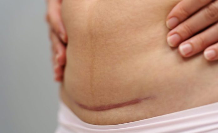 Ways To Keep The C-Section Incision Dry When Overweight - The Shoe Box NYC